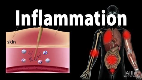 People Program Old — Inflammation Causes And Cures Of Chronic