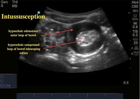 Intussusception ~ Ultrasound Cases Info Medical Ultrasound