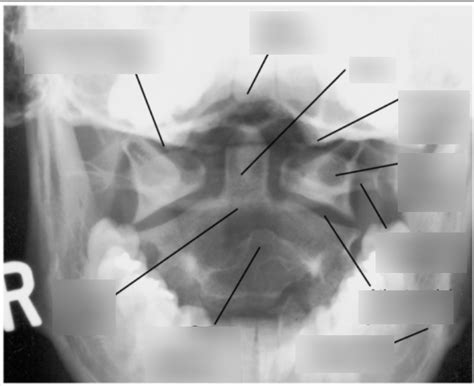 Diagram Of Odontoid Process Odontoid Fracture