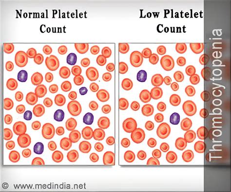 Hiv And Platelet Count Astonishingceiyrs