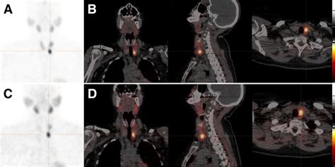 Simulated Fewer Angle Spect Ct Imaging Protocol For Parathyroid Adenoma