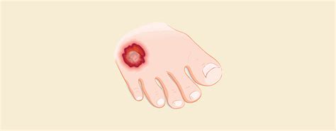 Difference Between Ecthyma Gangrenosum Vs Pyoderma Gangrenosum Knya