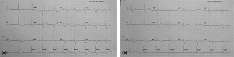 Post‐crt Ecgs A A‐paced Biv‐paced Ecg With R In V1 And Qrs Duration Download Scientific
