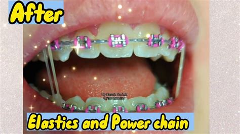 Power Chain Braces Before And After: Transform Your Smile