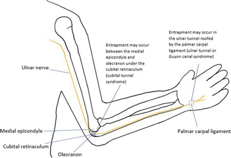 Ulnar Nerve Entrapment The Olympia Clinic