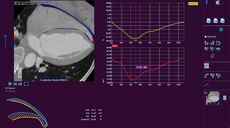 RV Strain Big Medisimaging