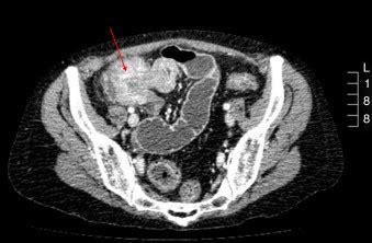 CT Scan Suggesting Ileo Colic Intussusceptions Arrow Download Scientific Diagram