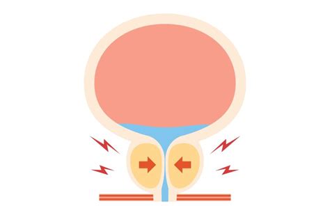 Medical Of Benign Prostatic Hyperplasia Enlarged Vector Image