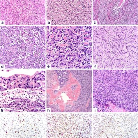 Different Sarcomatoid Patterns Are Identified In Sarcomatoid Carcinoma