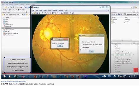 Dream Diabetic Retinopathy Analysis Using Machine Learning