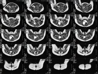 Practical Radiological Approach To A Case Of Intersex PPT