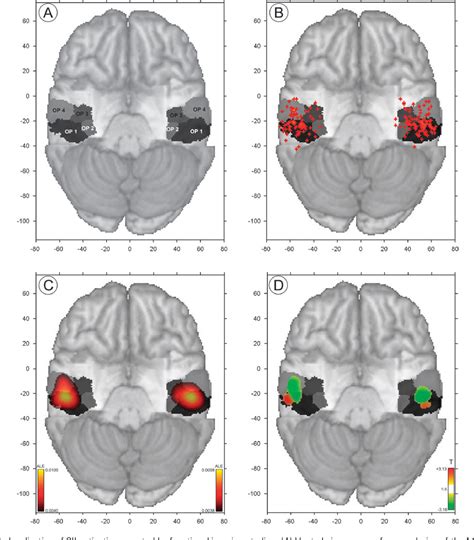 Figure 1 From The Human Parietal Operculum Ii Stereotaxic Maps And Correlation With Functional