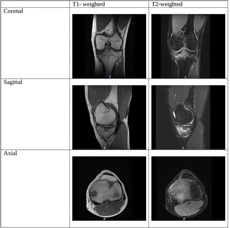 Proximal Tibia Chondroblastoma Mimicking An Osteochondral Defect