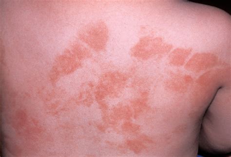 Phytophotodermatitis Plant Light Dermatitis Causes Symptoms And