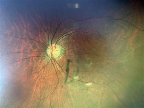 Flashes And Floaters In Calabasas Ca Visionary Retina Center