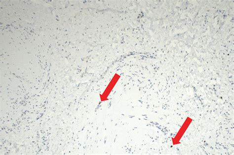 Immunohistochemical Expression Of Ki 67 Proliferative Antigen Mib 1 Download Scientific