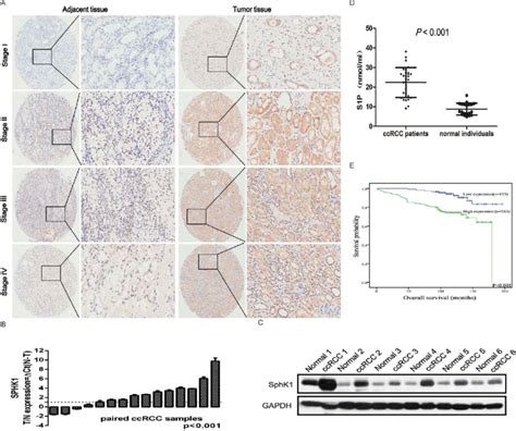 Sphk1 Expression Is Upregurated In Ccrcc Representative Download Scientific Diagram