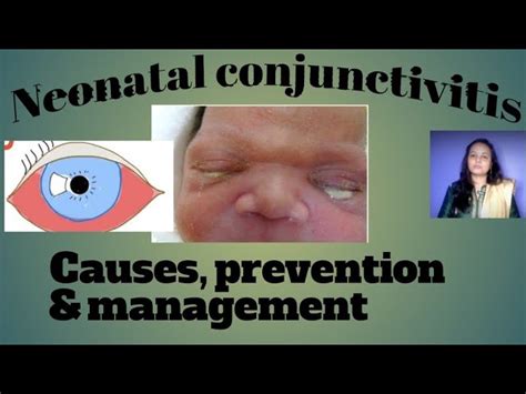 Neonatal Gonococcal Conjunctivitis Conjunctivitis Skin Deep