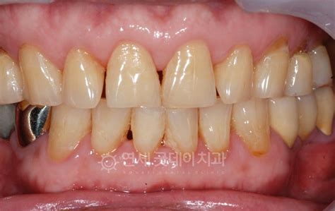 원데이치아미백 치료전후