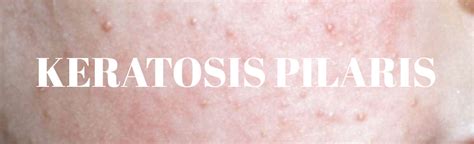 Keratosis Pilaris Beautyologist
