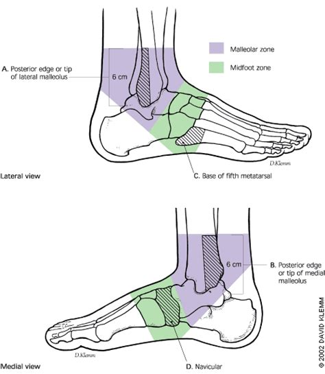 Foot Fractures Frequently Misdiagnosed As Ankle Sprains Artofit