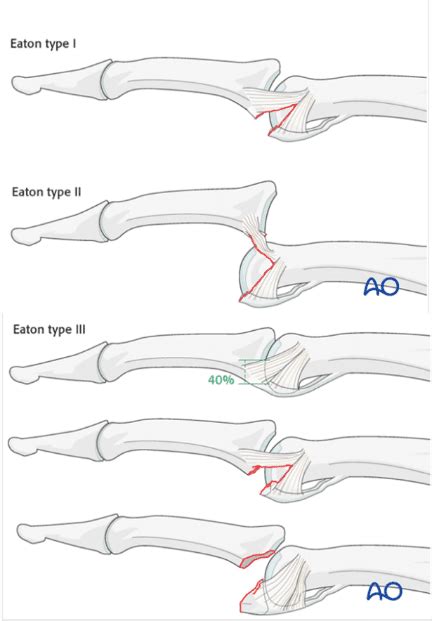 Phalangeal Fractures And Dislocations The Armdoc
