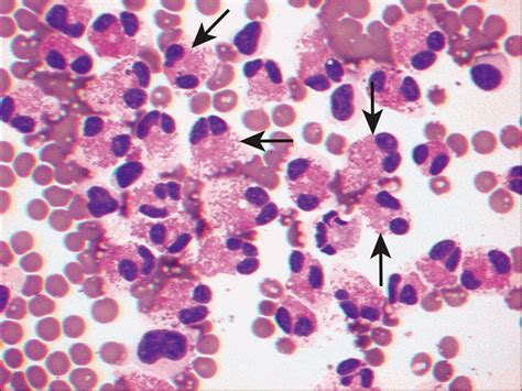 Serous Fluid Reactive Conditions Cytojournal