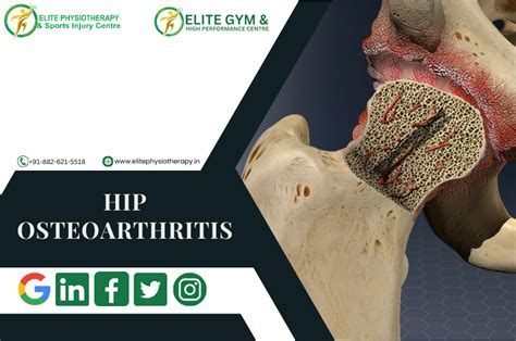 Hip Osteoarthritis And Its Treatment Without Surgery Elite Physio