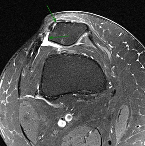 Partial Lateral Patellar Facetectomy
