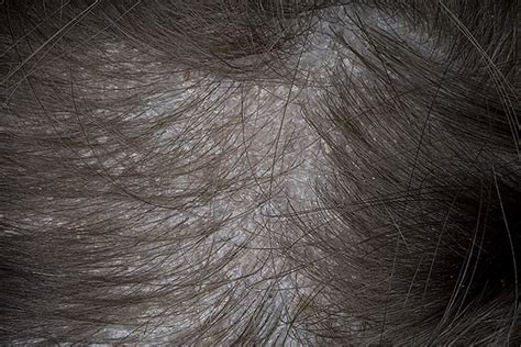 Trichomycosis Online Consultation Ai Dermatologist