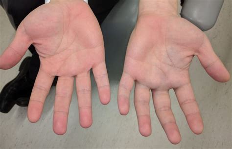 Metacarpal Fractures The Emergency Physio