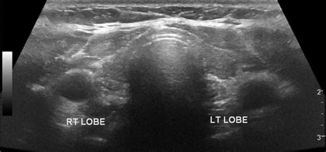 Enlarged Thyroid Ultrasound Image