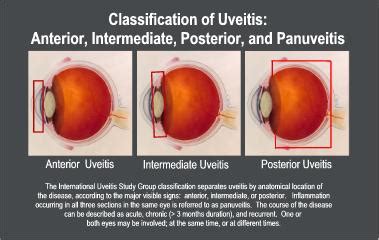 Anatomical Classification Of Uveitis TravisteFarmer