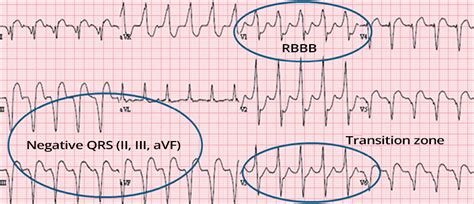 Ventricular Tachycardia Focus And Localization Ecg Book