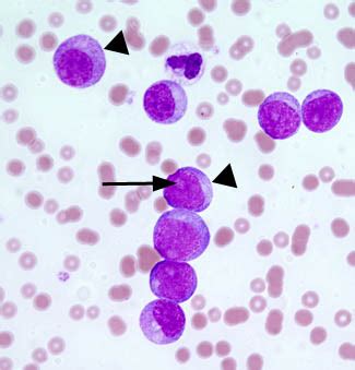 Acute Myeloid Leukemia Fine Fitness