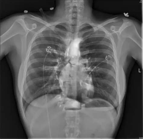Heart X Ray 🫀🫀💗💗🩻 Tumbex