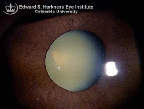 Phacolytic Glaucoma Vagelos College Of Physicians And Surgeons