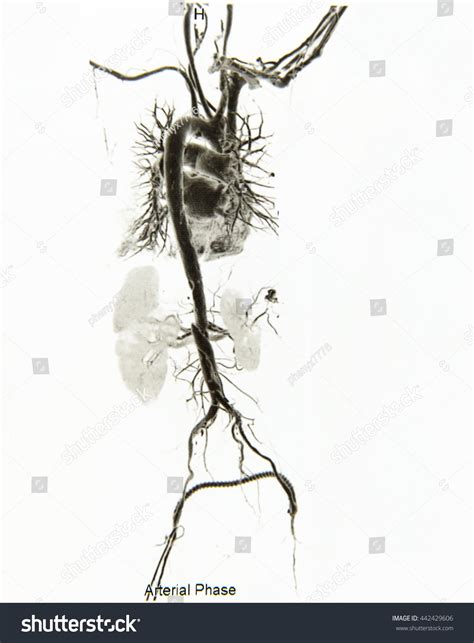 Film Ct Scan Angiography Take Photo Stock Photo Edit Now 442429606 Shutterstock