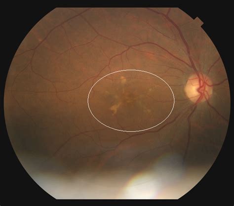 Butterfly Shaped Pattern Dystrophy An Observational Teaching Case Report The Journal Of