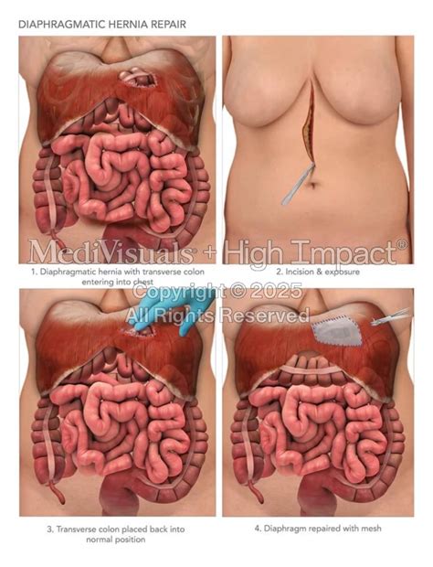 Diaphragmatic Hernia Repair