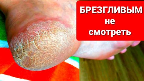 Как быстро удалить мозоли и натоптыши 👣 Очень простой способ Глубокие ...