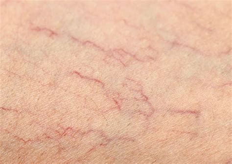 Arañas Vasculares Eliminar Las Arañas Vasculares Solución Inmediata Imr