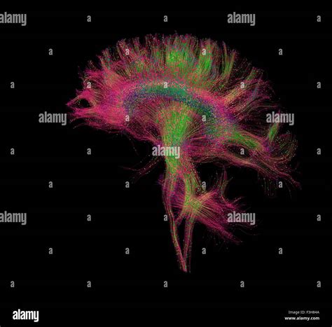 Diffusion MRI Also Referred To As Diffusion Tensor Imaging Or DTI Of The Human Brain Stock