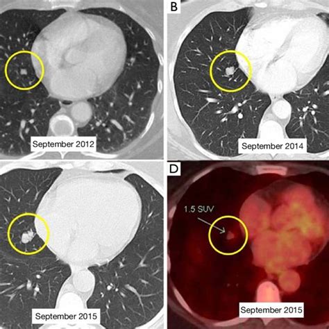 Fleischner Society 2017 Guidelines For Management Of Incidentally