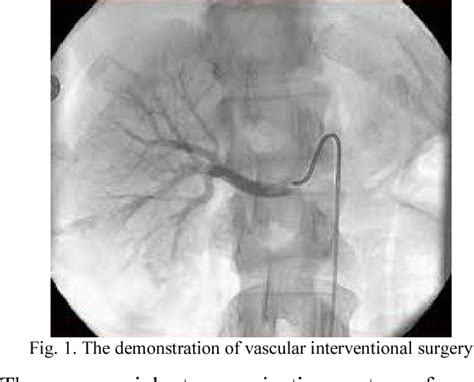 Figure 1 From Catheter Tracking Based On Multi Scale Filter And