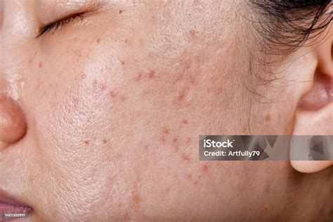 얼굴 피부 문제 성인의 여드름 질환 흰 머리 여드름으로 여자 얼굴을 닫고 기름기가 많은 얼굴 여드름 레이저 치료 후 발적과 붓기