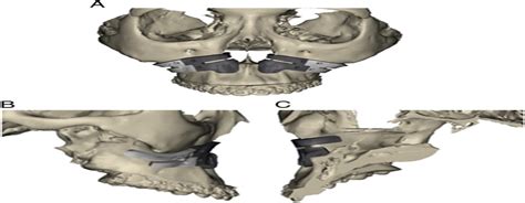 Extended Maxillary Osteotomy Guide A Design That Allows Man