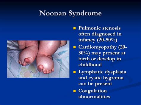 Ppt Common Genetic Syndromes And Their Medical Consequences