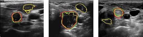 Figure 1 From Multi Task Learning For Thyroid Nodule Segmentation With Thyroid Region Prior