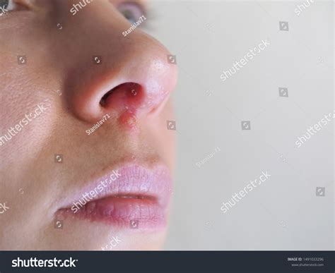 Herpes Simplex Under Nose At Rachel Vance Blog